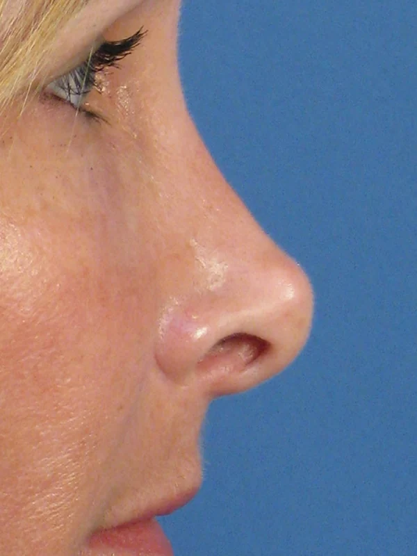 Rhinoplasty Composite Ear Grafts for Alar Retraction | Dr. Hilinski