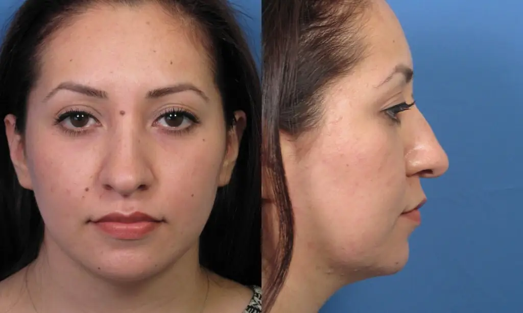 Hispanic Rhinoplasty Surgery Cosmetic Ethnic Nose Reshaping | Dr. Hilinski