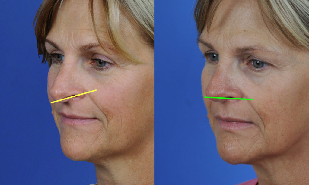 Droopy Nasal Tip Correction | Dr. Hilinski