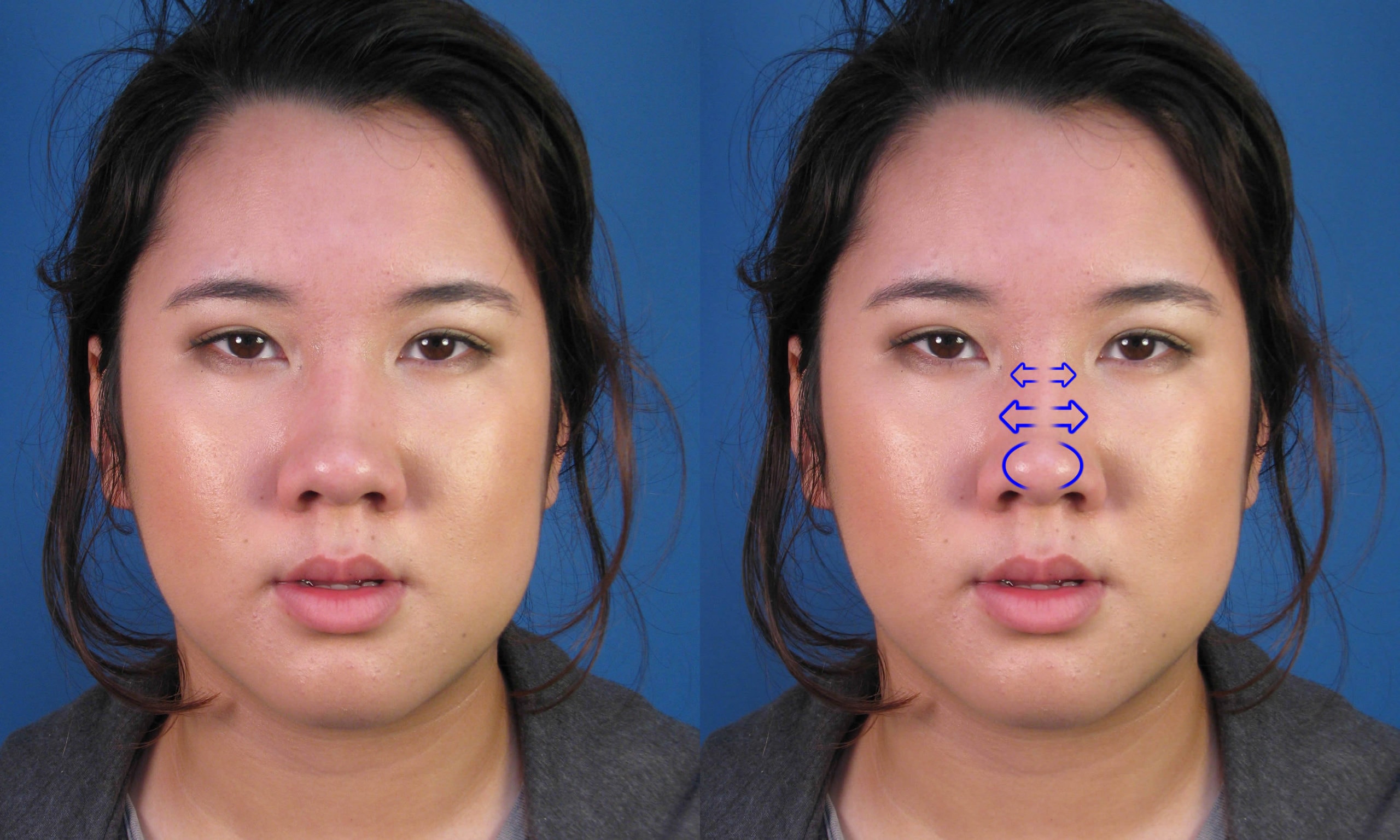 Asian Rhinoplasty Nose Job Surgery by Expert Ethnic Nose Surgeon Dr ...