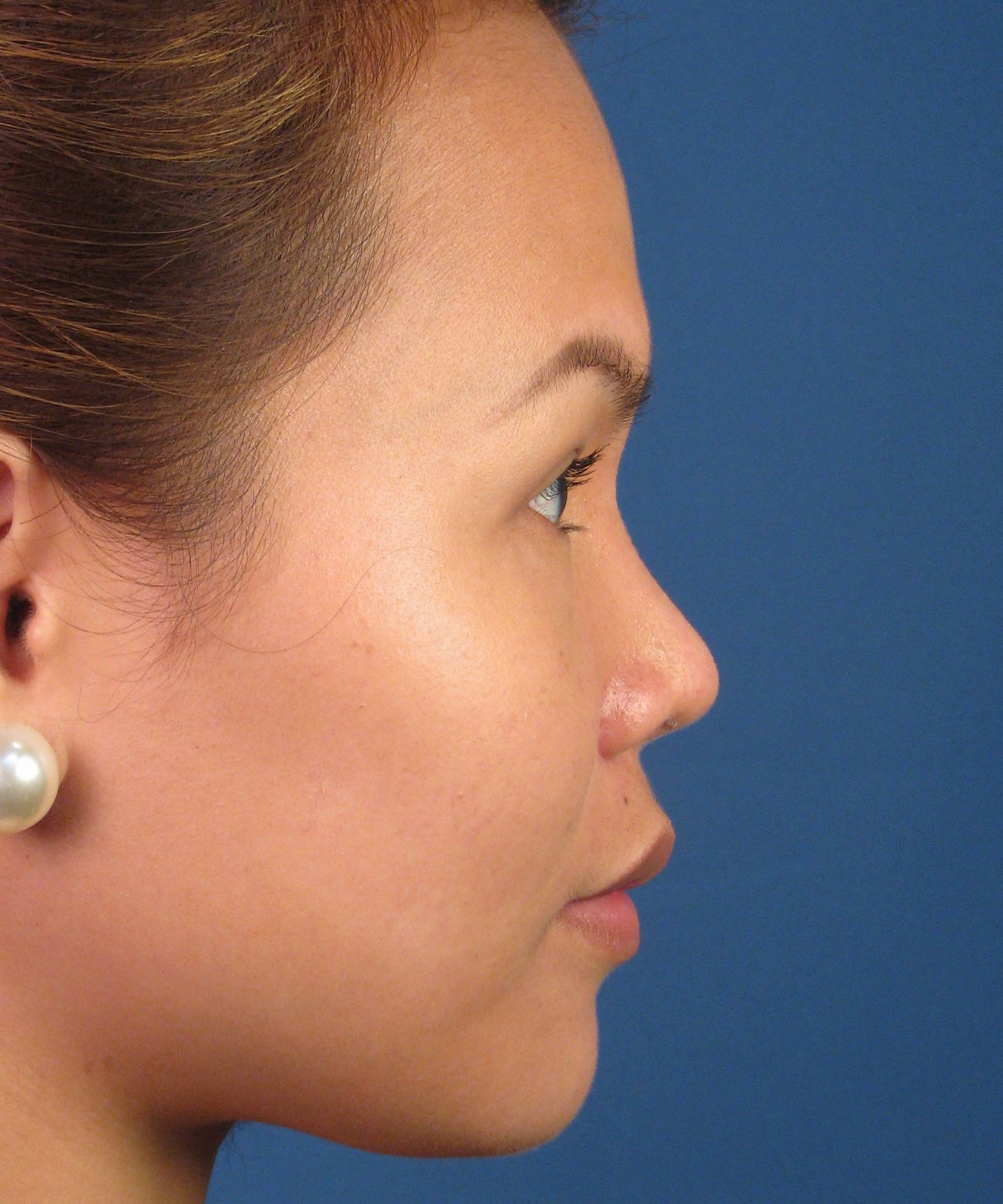 San Diego Asian Rhinoplasty Expert - Dr. John Hilinski - Nose Reshaping ...