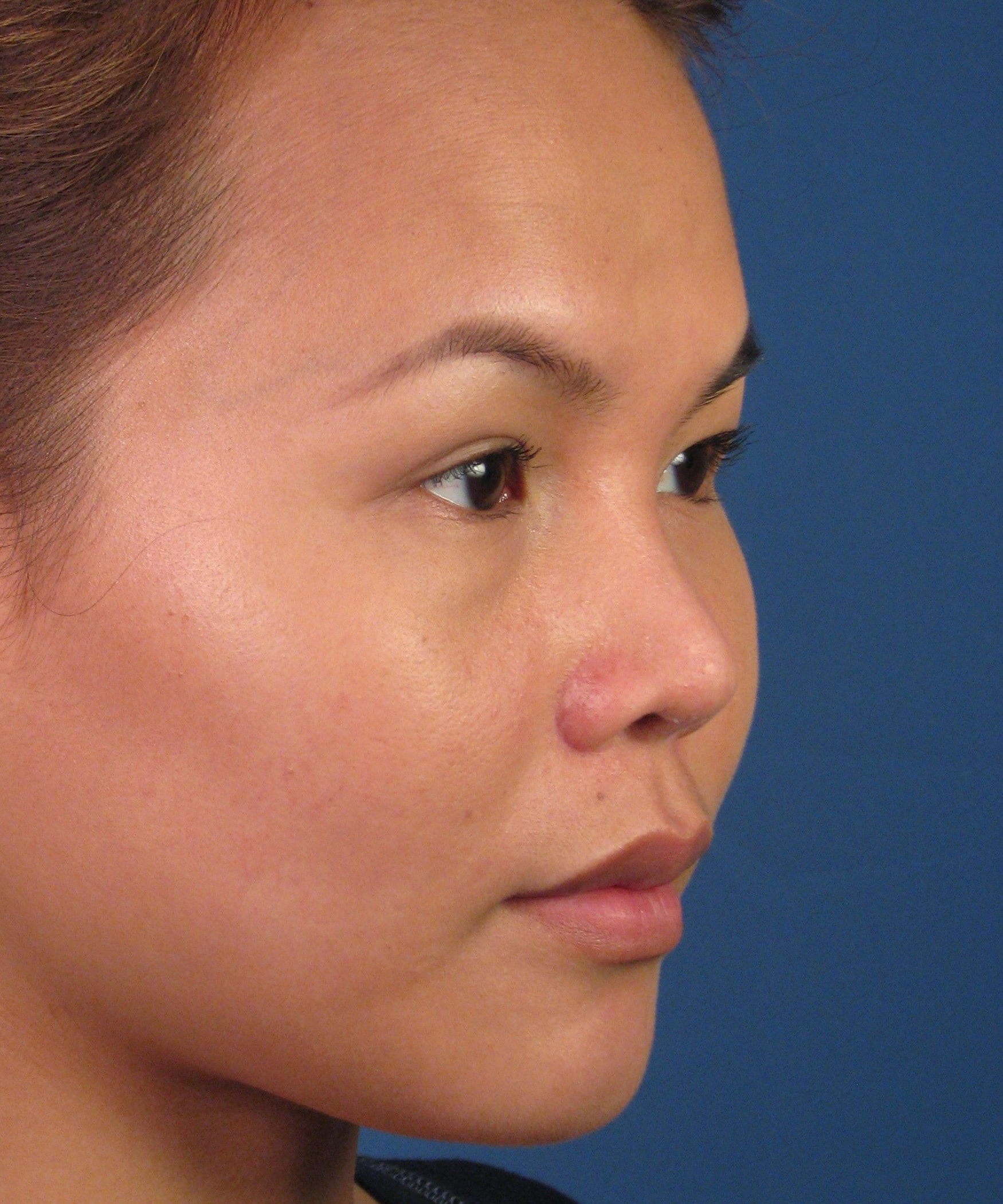 San Diego Asian Rhinoplasty Expert - Dr. John Hilinski - Nose Reshaping ...