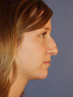 Nasal Analysis Rhinoplasty San Diego La Jolla CA | Dr. Hilinski
