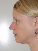 Nasal Analysis Rhinoplasty San Diego La Jolla CA | Dr. Hilinski