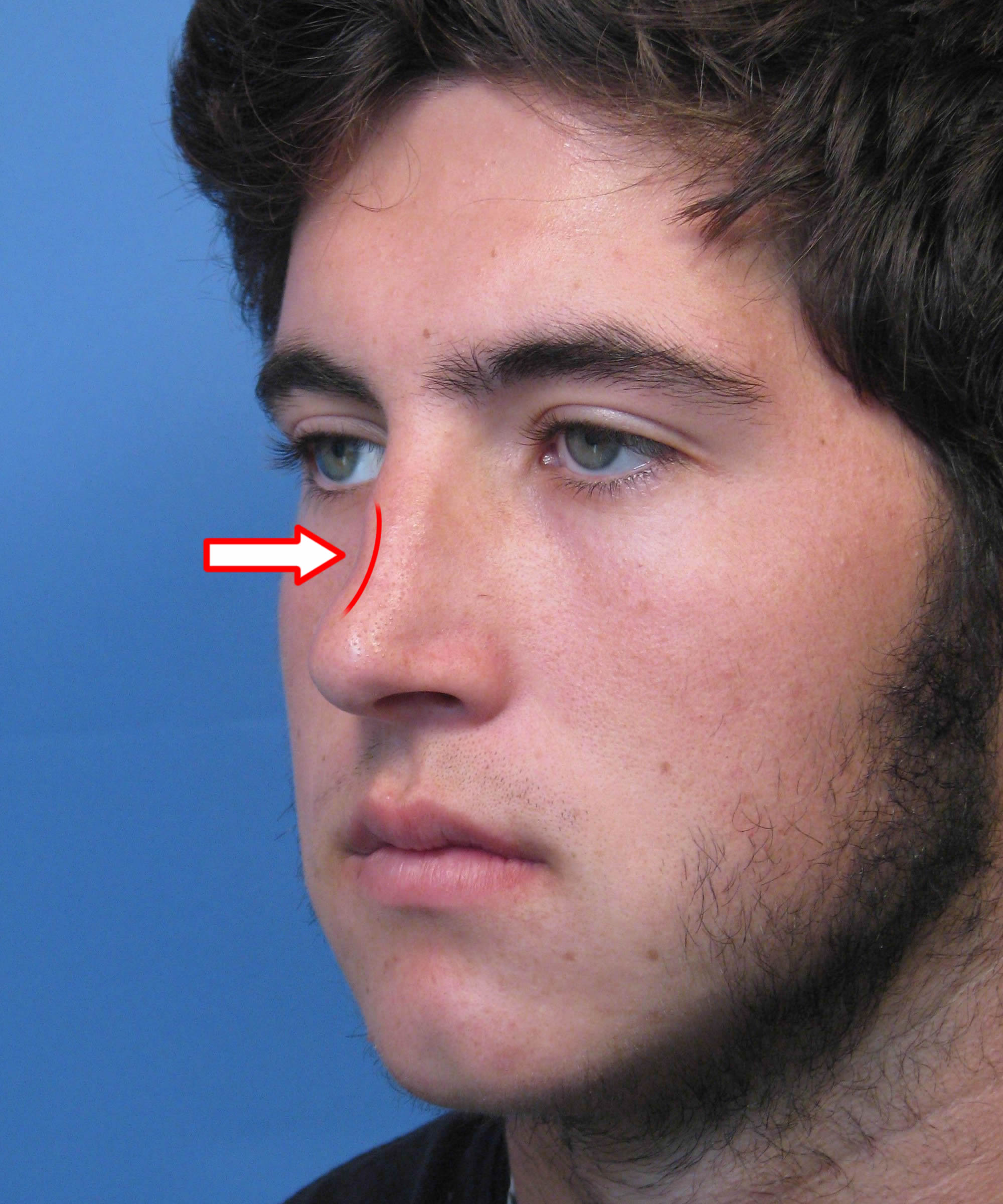 Rhinoplasty Crooked Nose Surgery | Dr. Hilinski