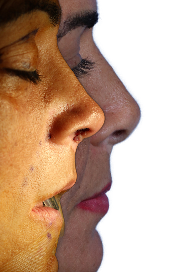 Truncated Short Nasal Tip | Dr. Hilinski