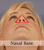 Nasal Analysis Rhinoplasty San Diego La Jolla CA | Dr. Hilinski