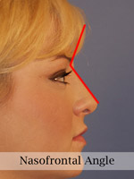 Nasal Analysis Rhinoplasty San Diego La Jolla CA | Dr. Hilinski