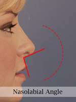 Nasal Analysis Rhinoplasty San Diego La Jolla CA | Dr. Hilinski