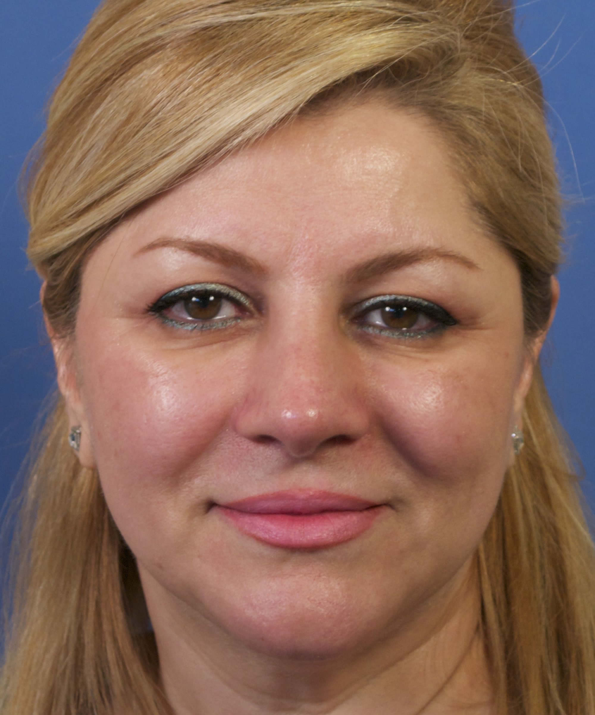 Persian Middle Eastern Rhinoplasty Dr Hilinski