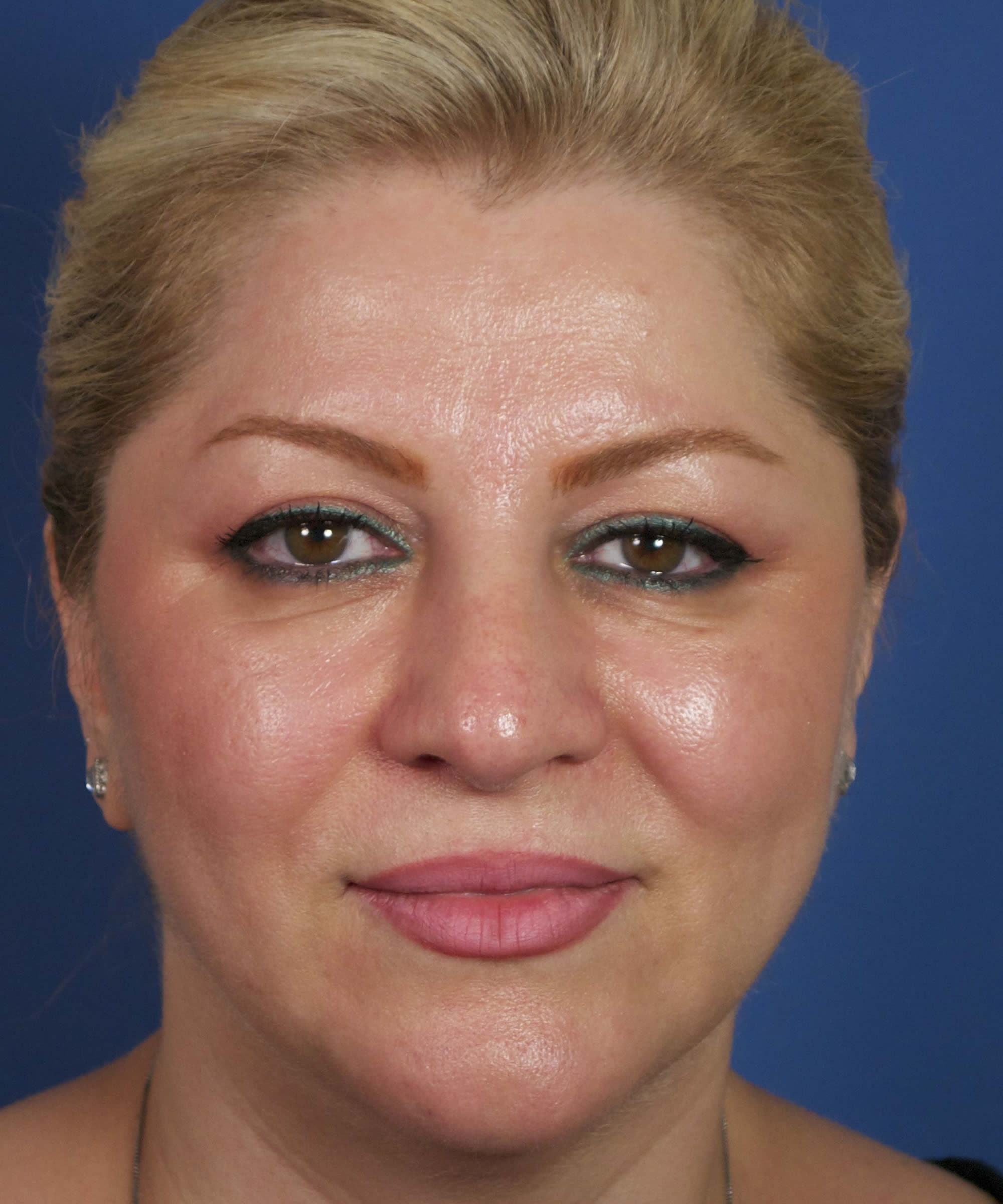 Persian Middle Eastern Rhinoplasty | Dr. Hilinski