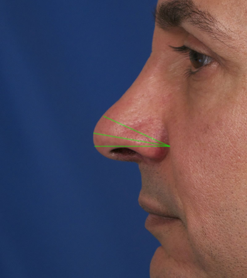 Revision Rhinoplasty Tip Rebuilding | Dr. Hilinski