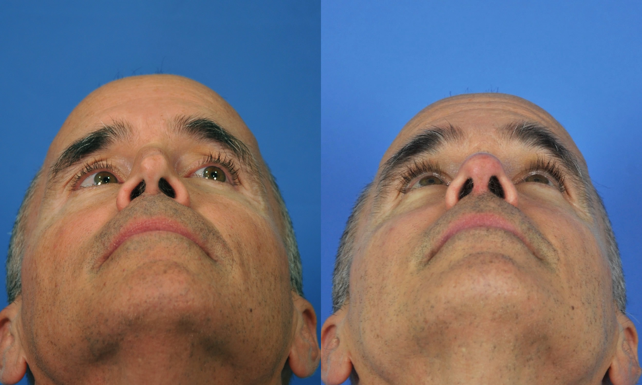 Pinched Nasal Tip Repair | Dr. Hilinski