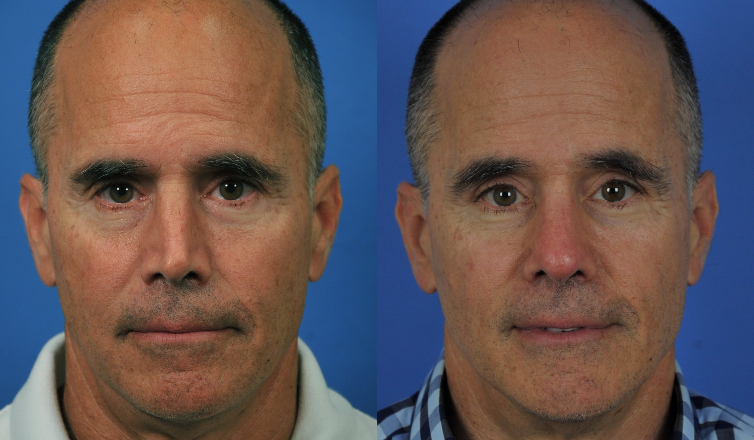 Pinched Nasal Tip Repair | Dr. Hilinski