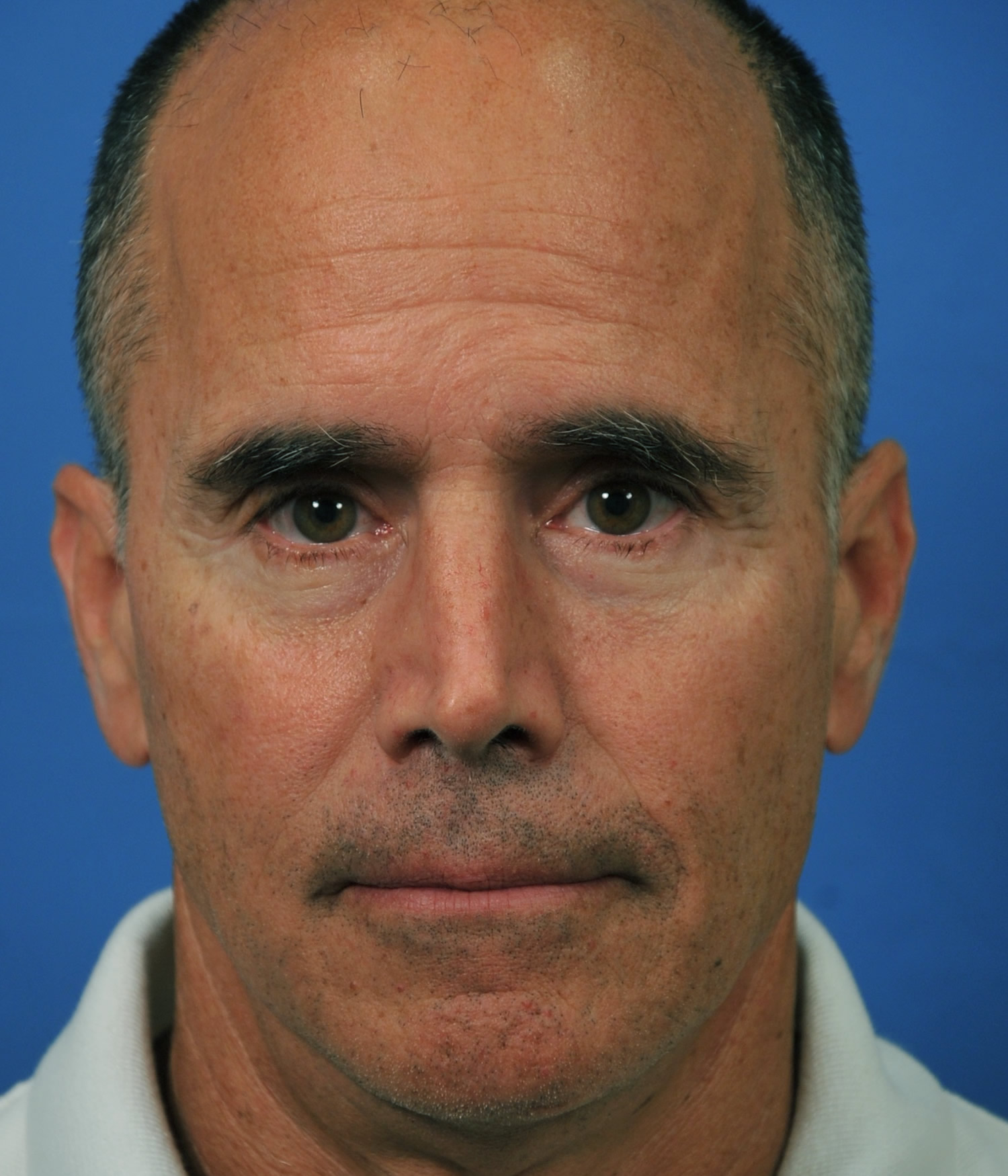 Pinched Nasal Tip Repair | Dr. Hilinski