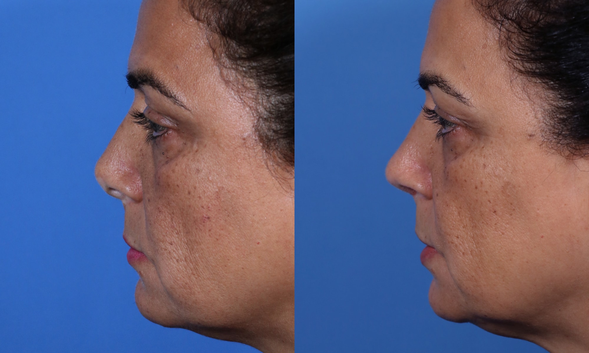 Truncated Short Nasal Tip | Dr. Hilinski