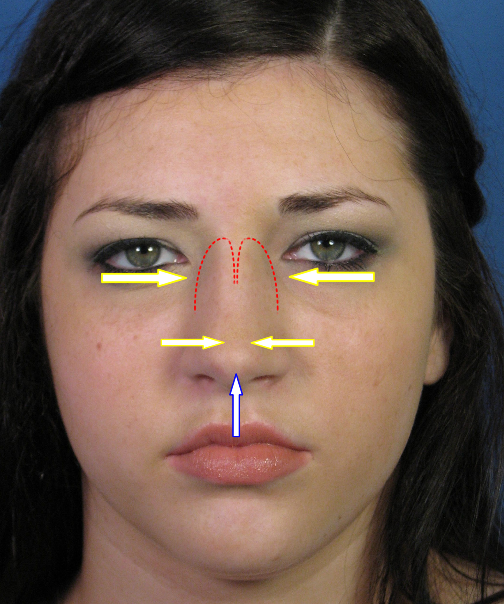 Dramatic Cosmetic Rhinoplasty Changes | Dr. Hilinski