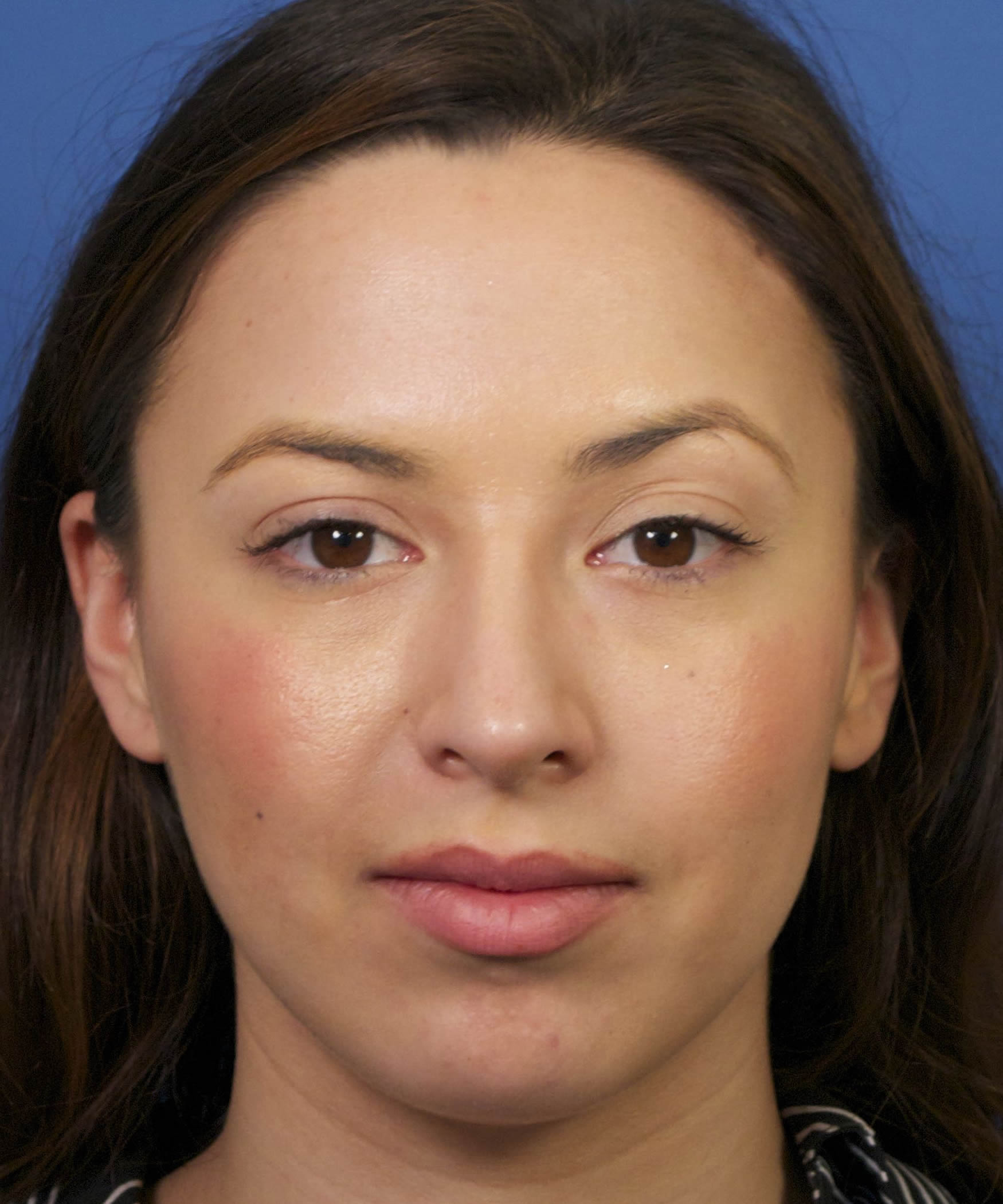 Bulbous Wide Nasal Tip Rhinoplasty Surgery | Dr. Hilinski