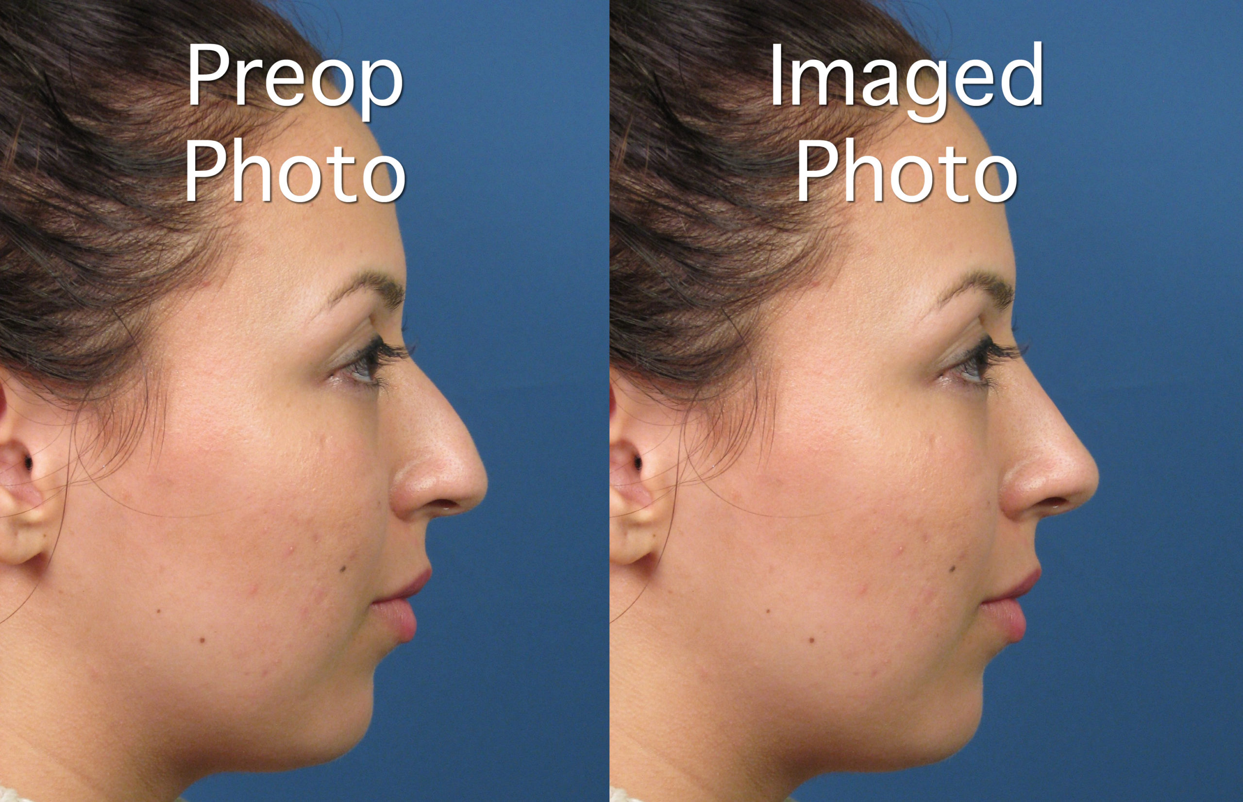 Bulbous Wide Nasal Tip Rhinoplasty Surgery | Dr. Hilinski