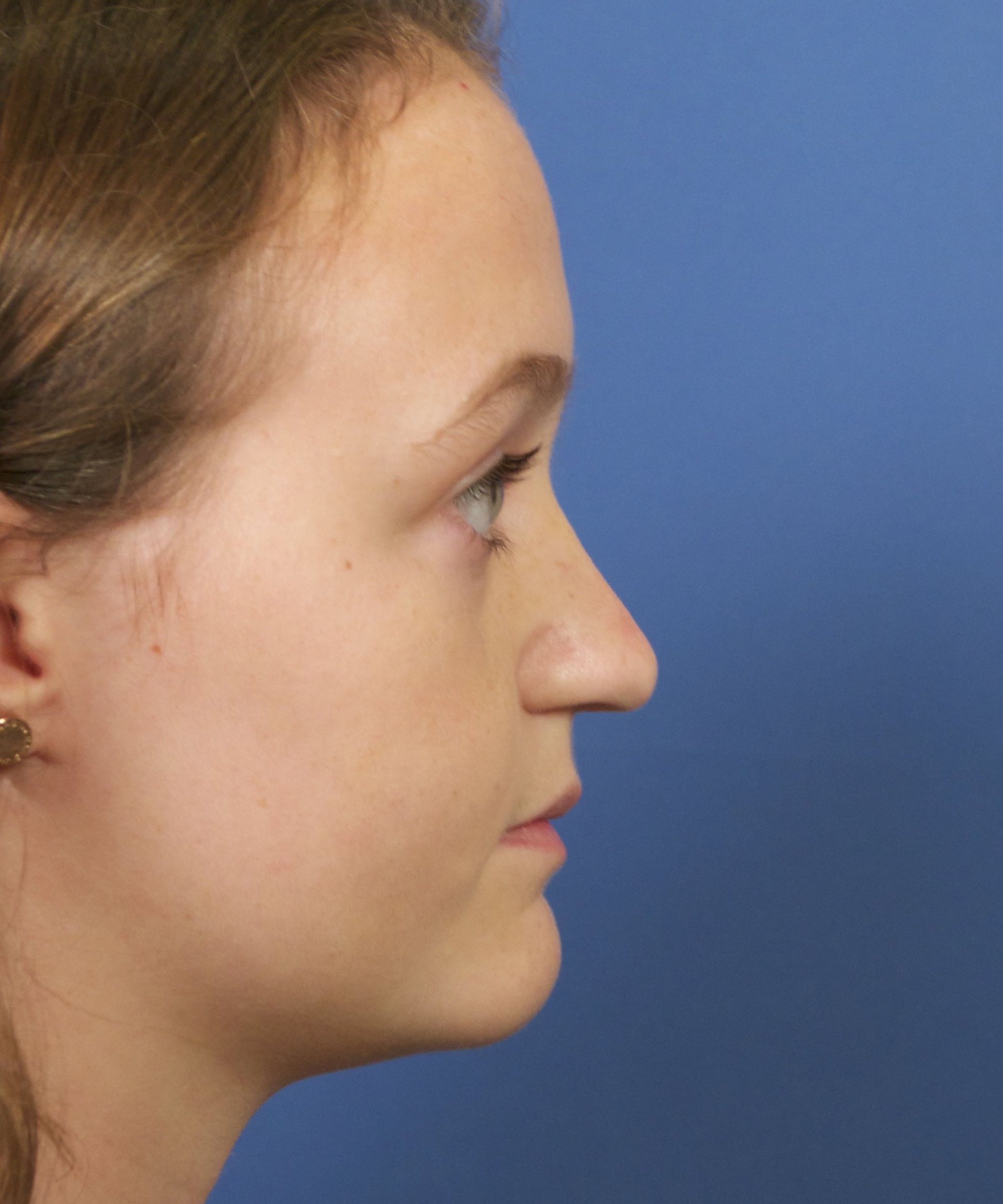 Teenage Droopy Nasal Tip Rhinoplasty | Dr. Hilinski