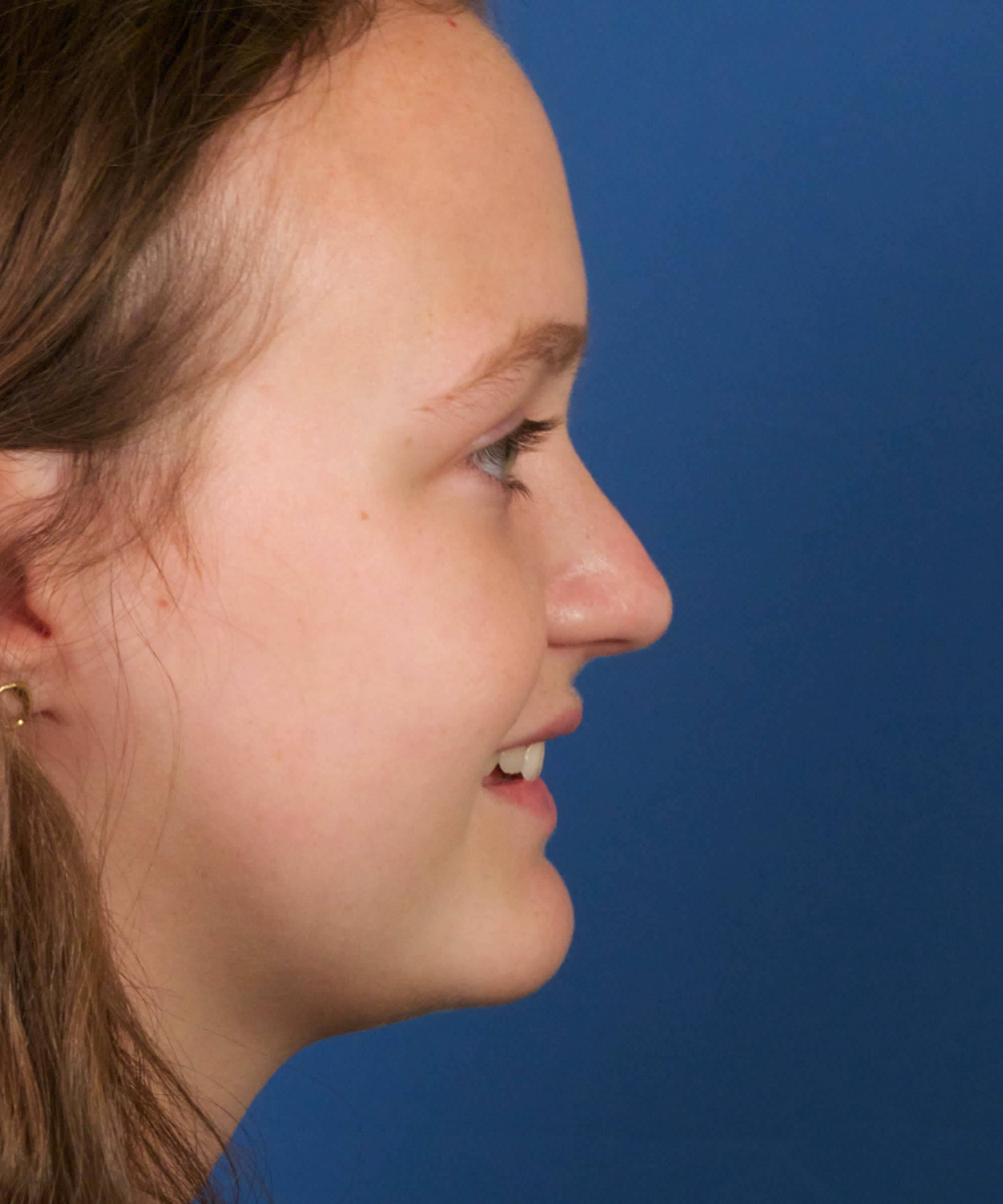 Teenage Droopy Nasal Tip Rhinoplasty | Dr. Hilinski