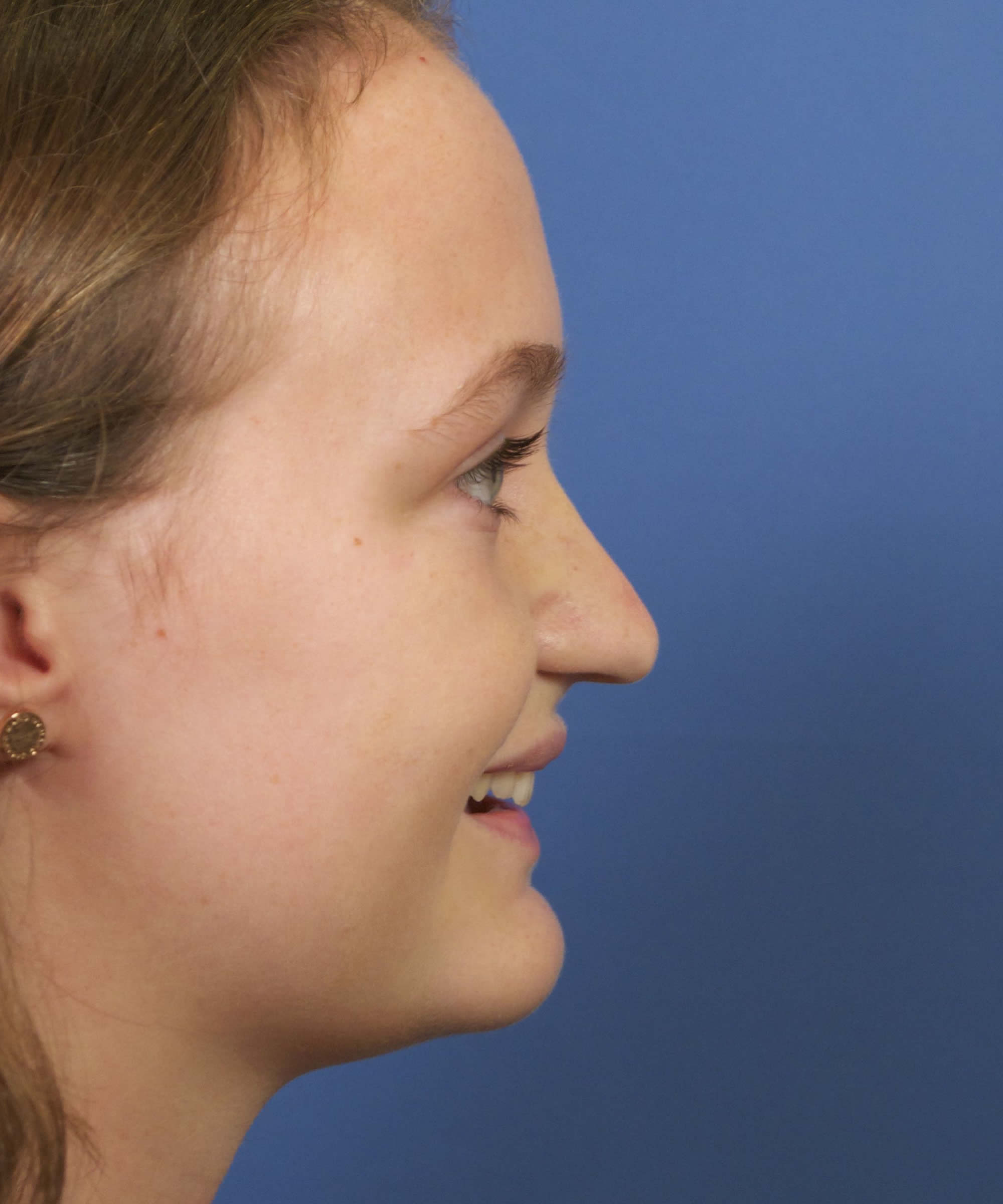 Teenage Droopy Nasal Tip Rhinoplasty | Dr. Hilinski