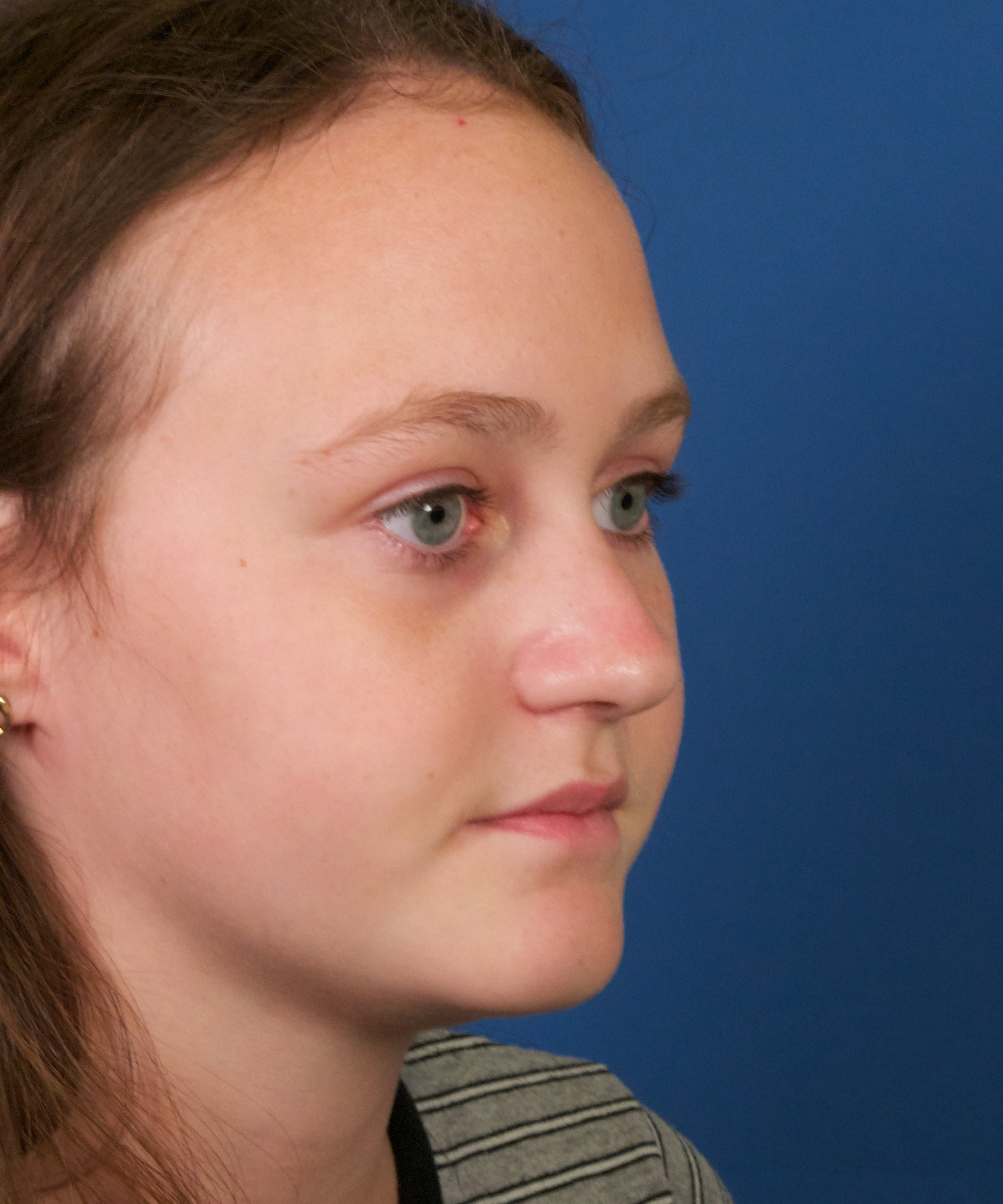 Teenage Droopy Nasal Tip Rhinoplasty | Dr. Hilinski