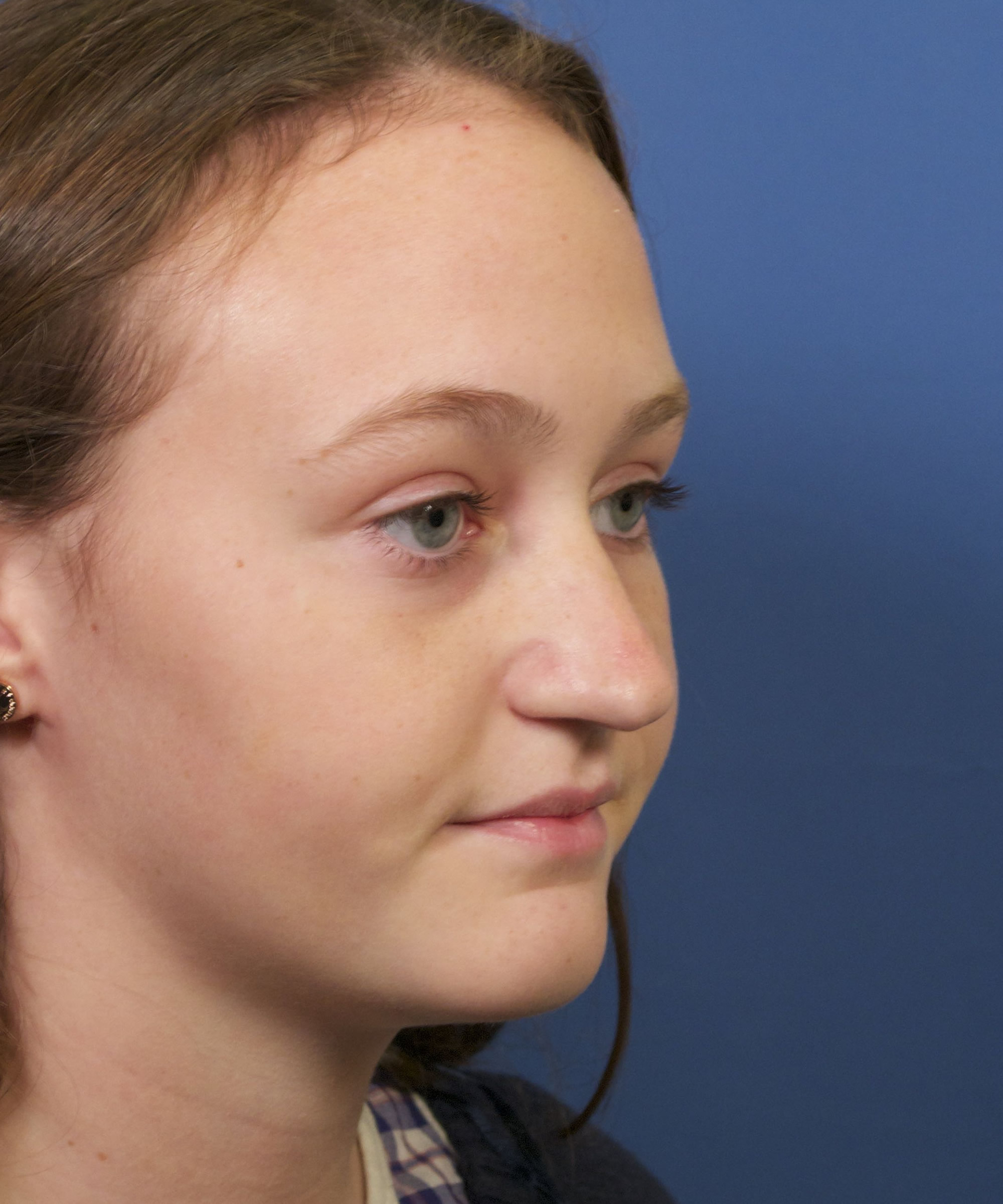 Teenage Droopy Nasal Tip Rhinoplasty | Dr. Hilinski