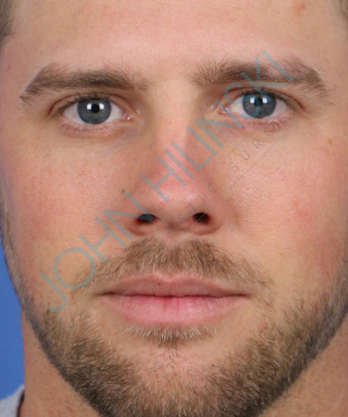 Caudal Septum Deviation | Dr. Hilinski