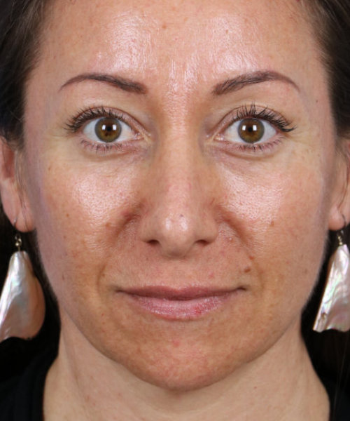 Reshaping A Hanging Columella | Dr. Hilinski