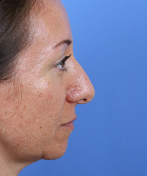 Reshaping A Hanging Columella | Dr. Hilinski