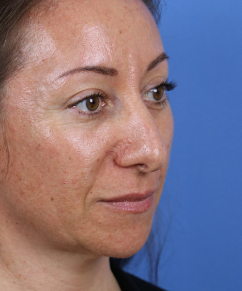 Reshaping A Hanging Columella | Dr. Hilinski