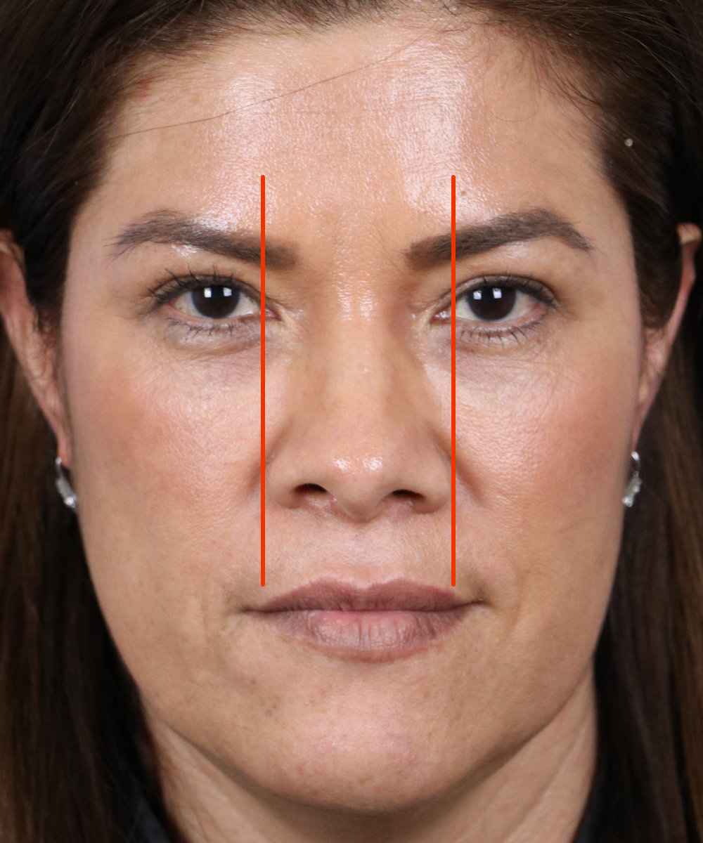 Bridge, Tip and Base Narrowing | Dr. Hilinski