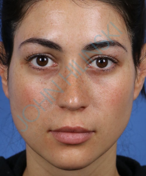 Narrowing A Wide Nose in San Diego by Dr. Hilinski | San Diego ...