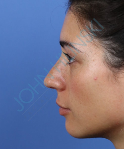 Narrowing A Wide Nose in San Diego by Dr. Hilinski | San Diego ...