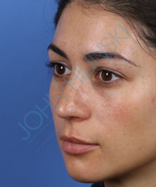 Narrowing A Wide Nose in San Diego by Dr. Hilinski | San Diego ...