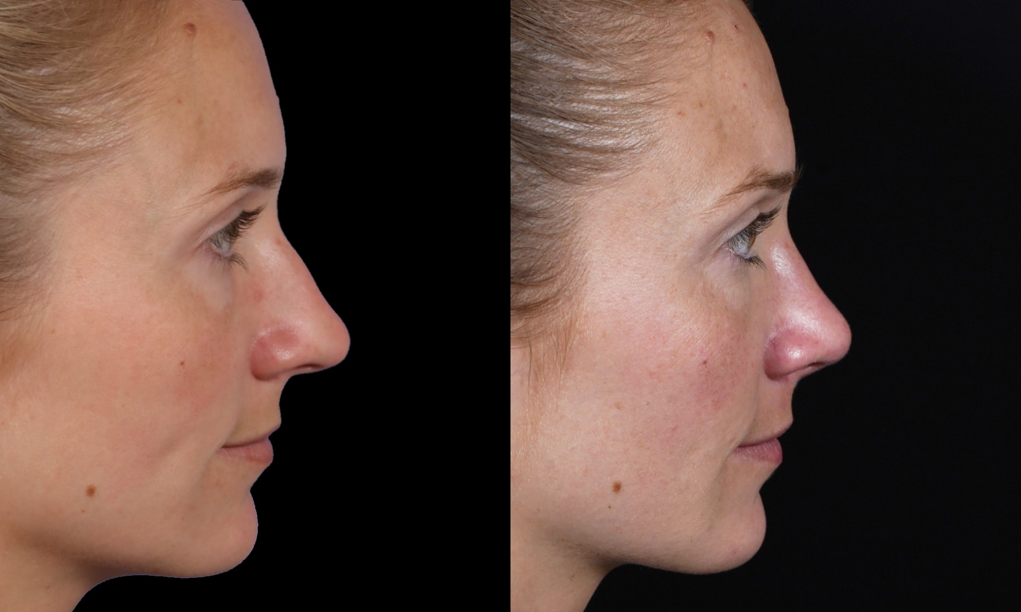 Preservation Rhinoplasty Bridge Reduction | Dr. Hilinski