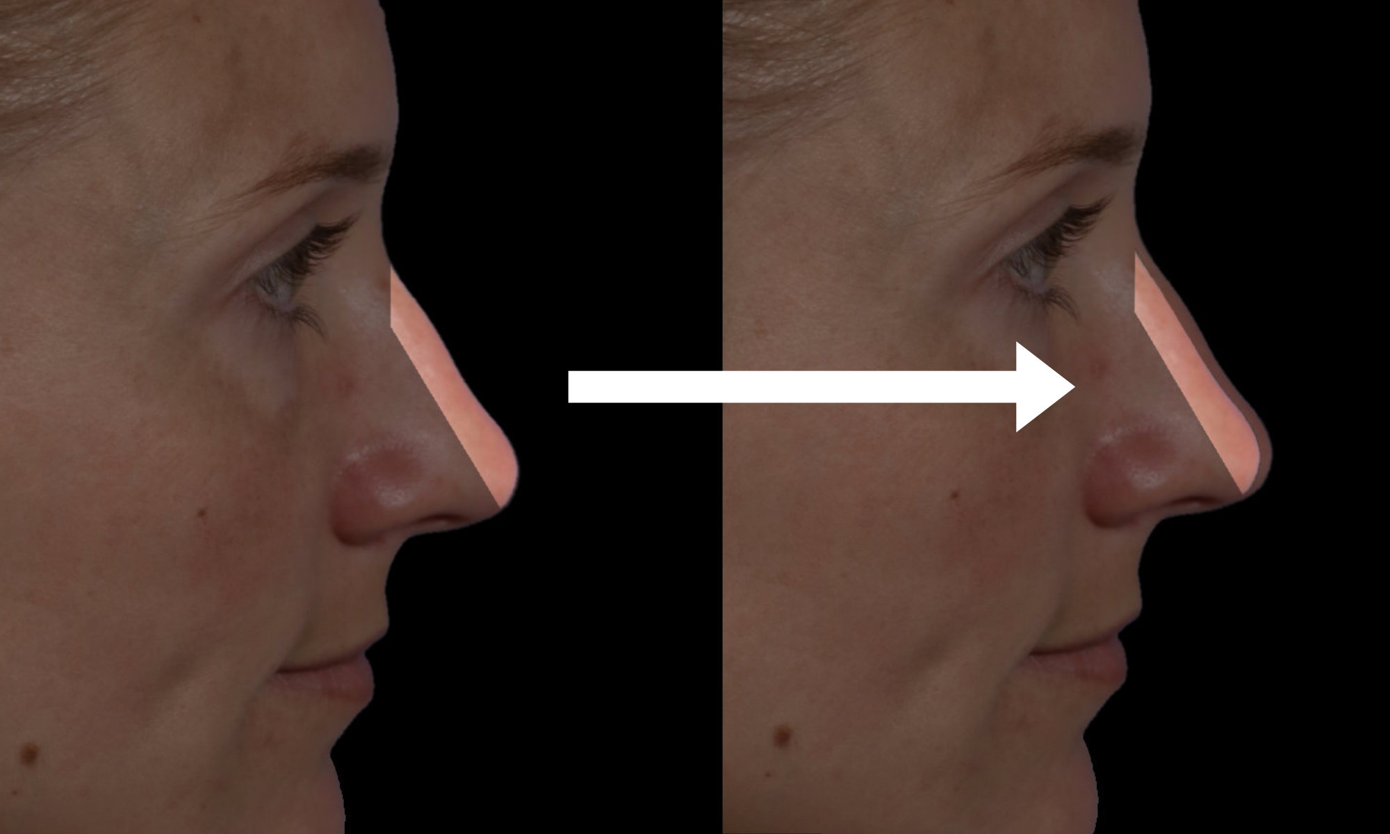 Preservation Rhinoplasty Bridge Reduction | Dr. Hilinski