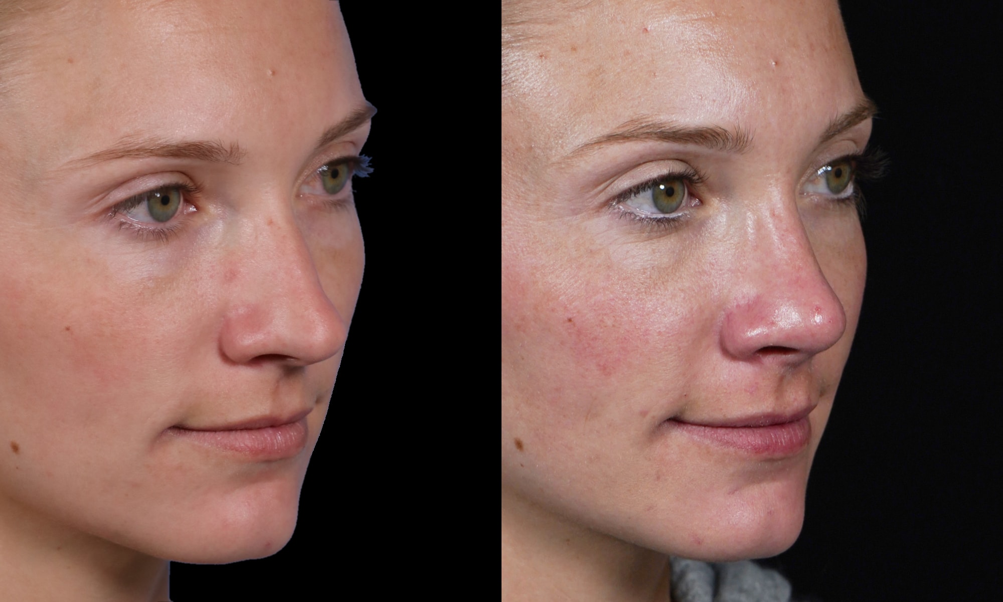 Preservation Rhinoplasty Bridge Reduction | Dr. Hilinski