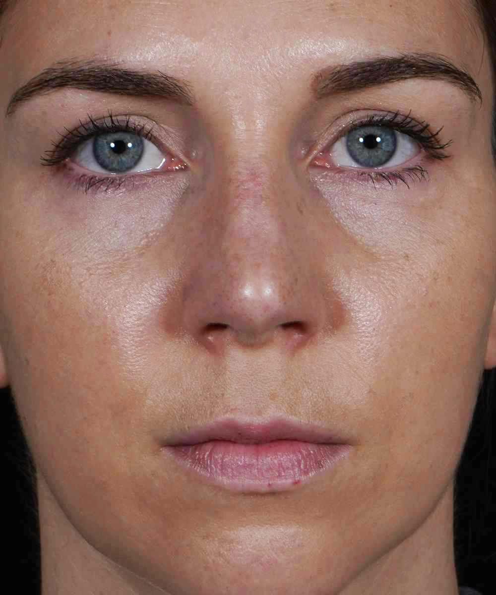 Crooked Nose Correction | Dr. Hilinski
