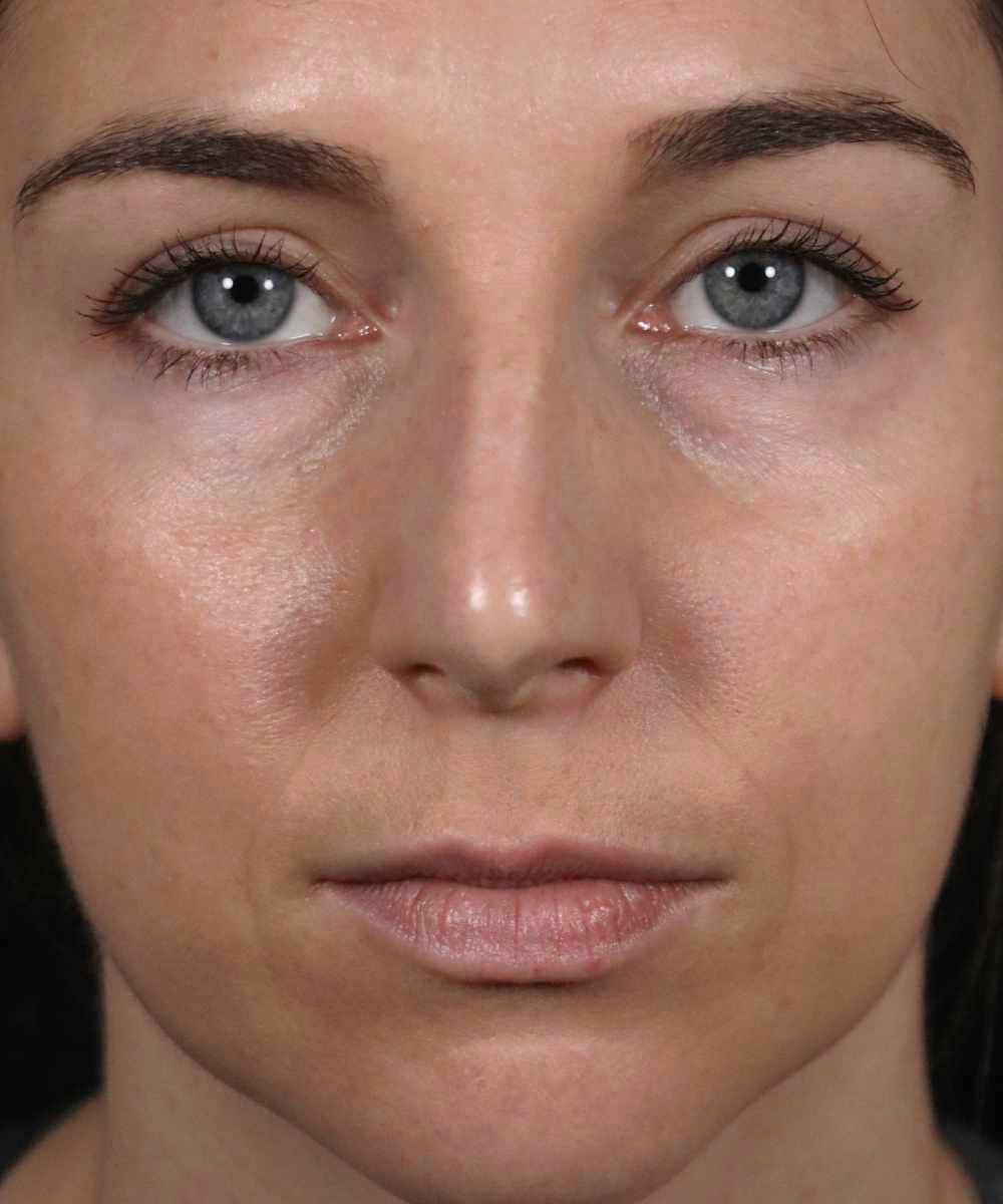 Crooked Nose Correction | Dr. Hilinski