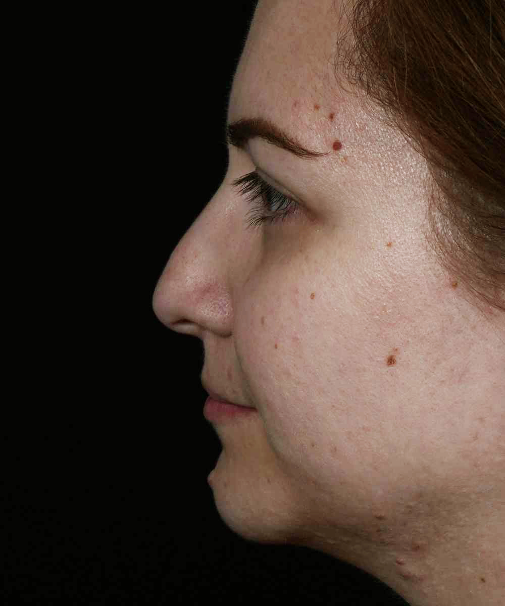 What Is Preservation Rhinoplasty? | Dr. Hilinski