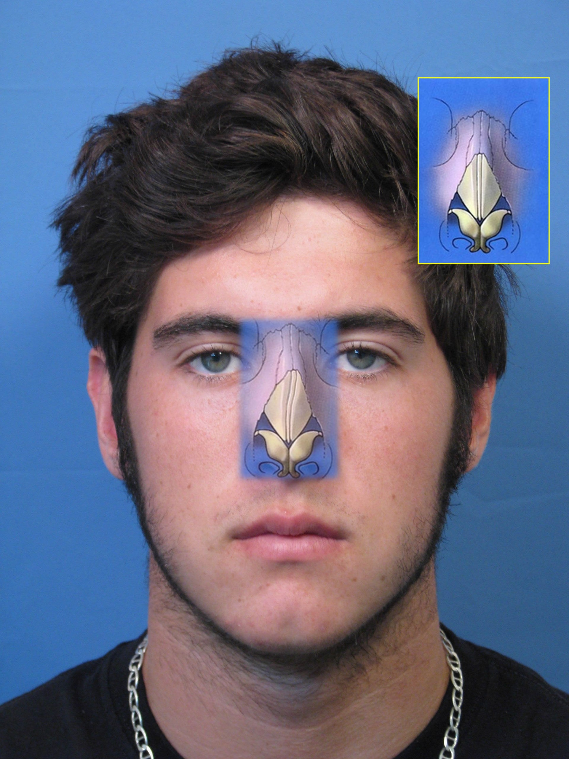 Rhinoplasty Crooked Nose Surgery | Dr. Hilinski