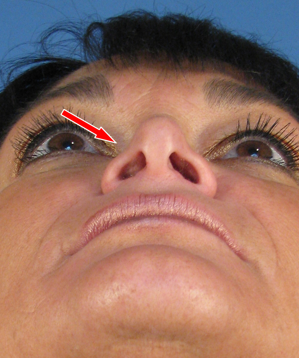 San Diego Rhinoplasty - Pinched Nasal Tip | Dr. Hilinski