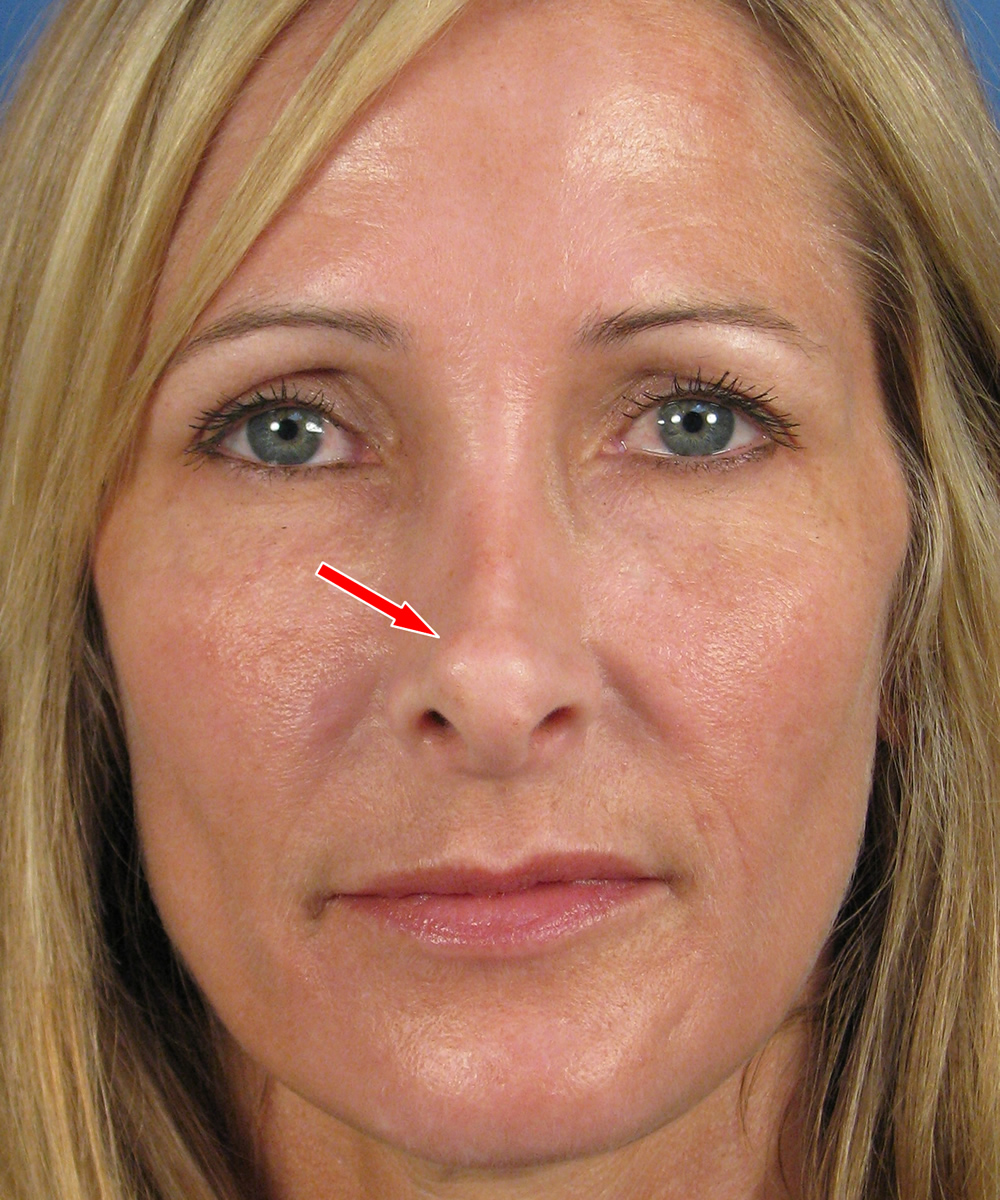 San Diego Rhinoplasty - Pinched Nasal Tip | Dr. Hilinski