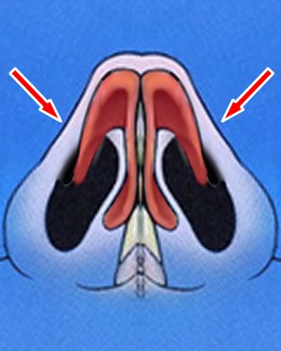 San Diego Rhinoplasty - Pinched Nasal Tip | Dr. Hilinski