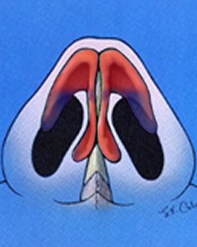 San Diego Rhinoplasty - Pinched Nasal Tip | Dr. Hilinski