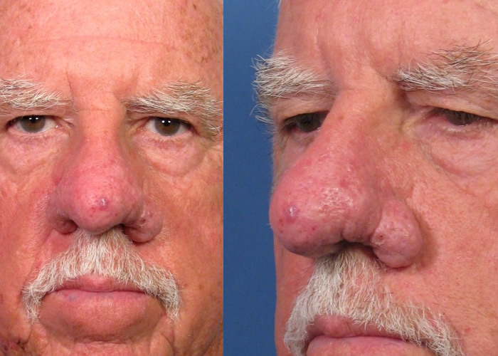 Rhinophyma of the Nose Treatment and Surgery in San Diego, CA | Dr ...