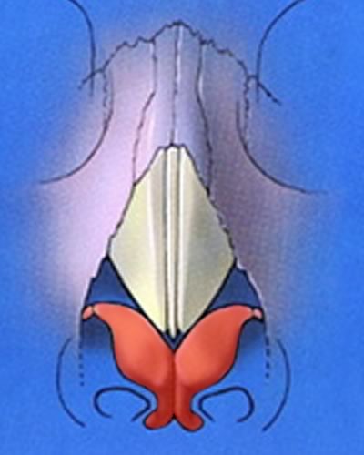 San Diego Rhinoplasty - Pinched Nasal Tip | Dr. Hilinski