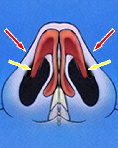 San Diego Rhinoplasty - Pinched Nasal Tip | Dr. Hilinski